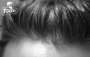 Patch cutanea per capelli: quanto costa?